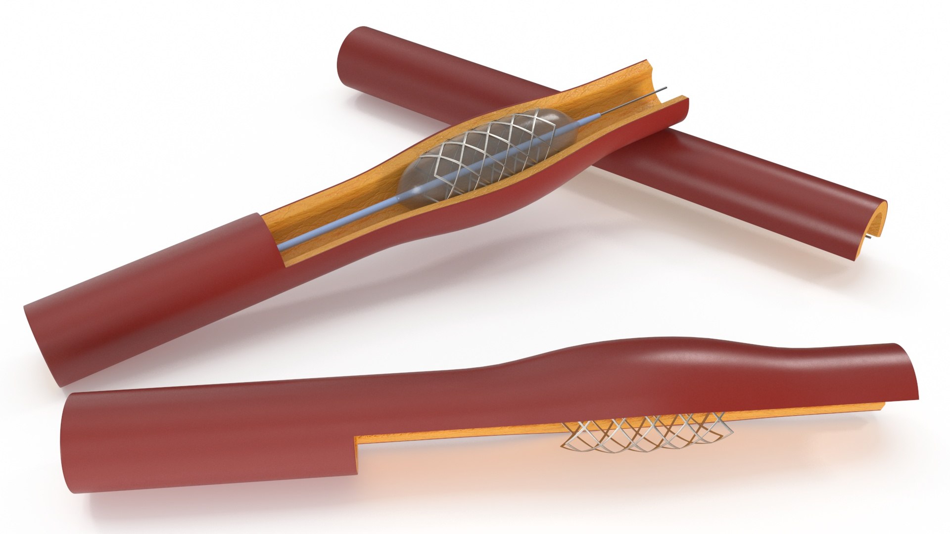 Plastic Models Of Stents With Artery 3D Model - TurboSquid 2239722