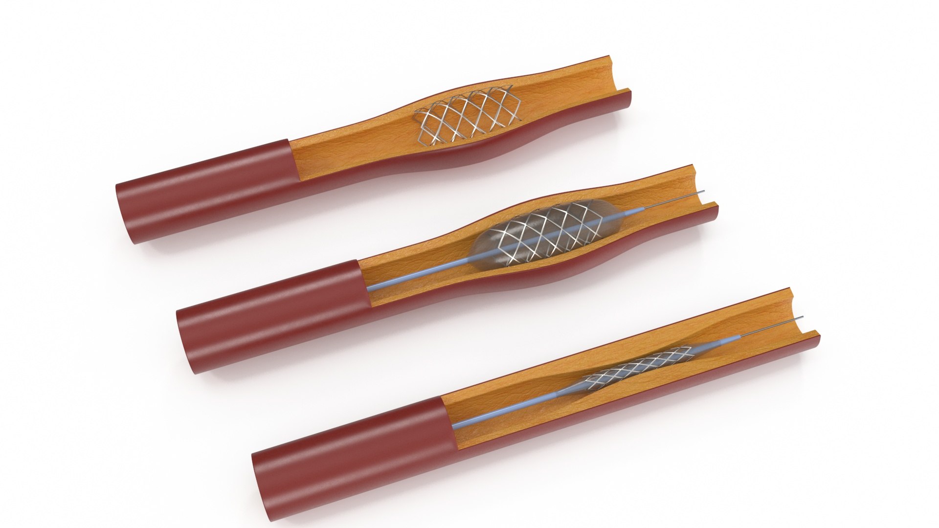 Plastic Models Of Stents With Artery 3D Model - TurboSquid 2239722