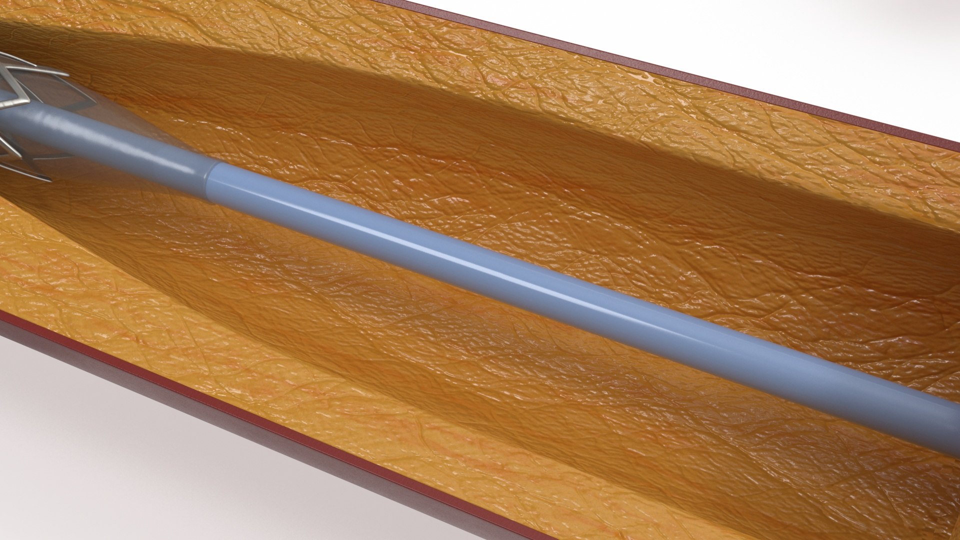 Plastic Models Of Stents With Artery 3D Model - TurboSquid 2239722