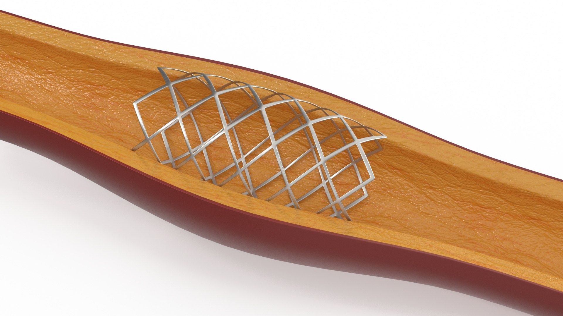 Plastic Models Of Stents With Artery 3D Model - TurboSquid 2239722