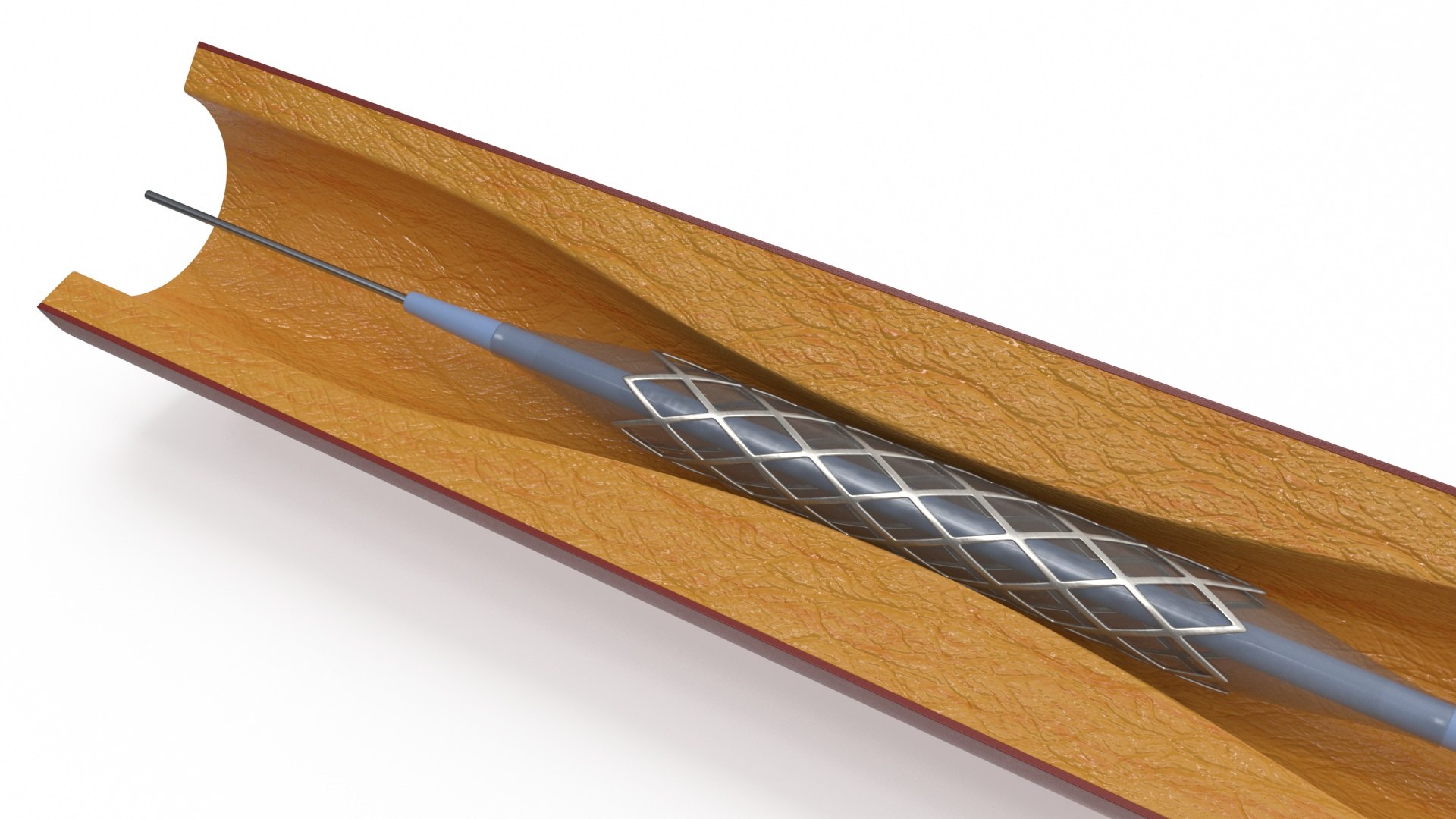 Plastic Models Of Stents With Artery 3D Model - TurboSquid 2239722