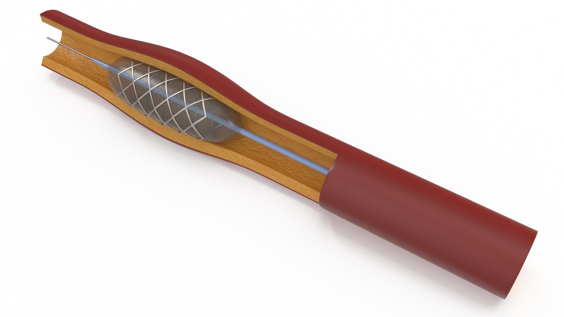 Plastic Models Of Stents With Artery 3D Model - TurboSquid 2239722