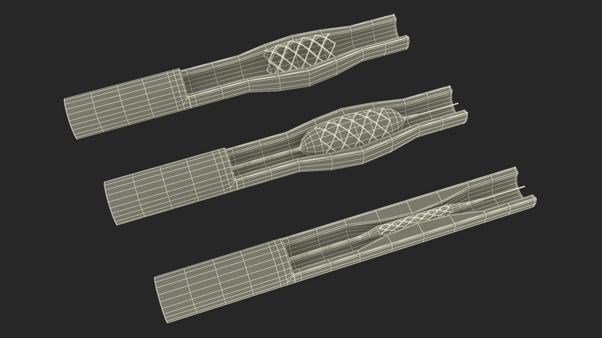 Plastic Models Of Stents With Artery 3D Model - TurboSquid 2239722