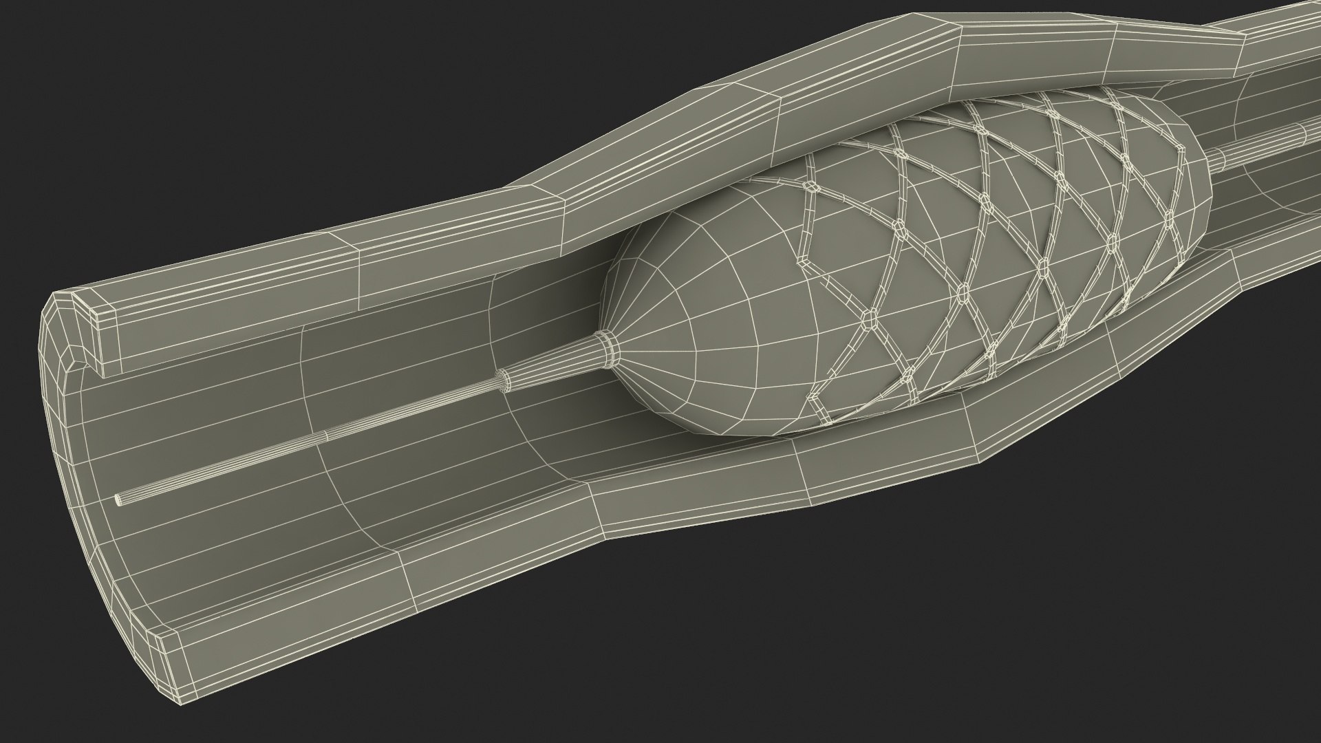 Plastic Models Of Stents With Artery 3D Model - TurboSquid 2239722