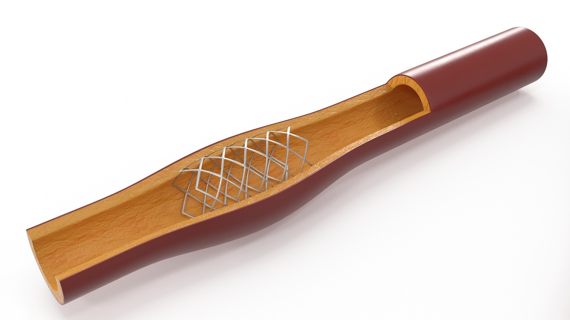 Plastic Models Of Stents With Artery 3D Model - TurboSquid 2239722