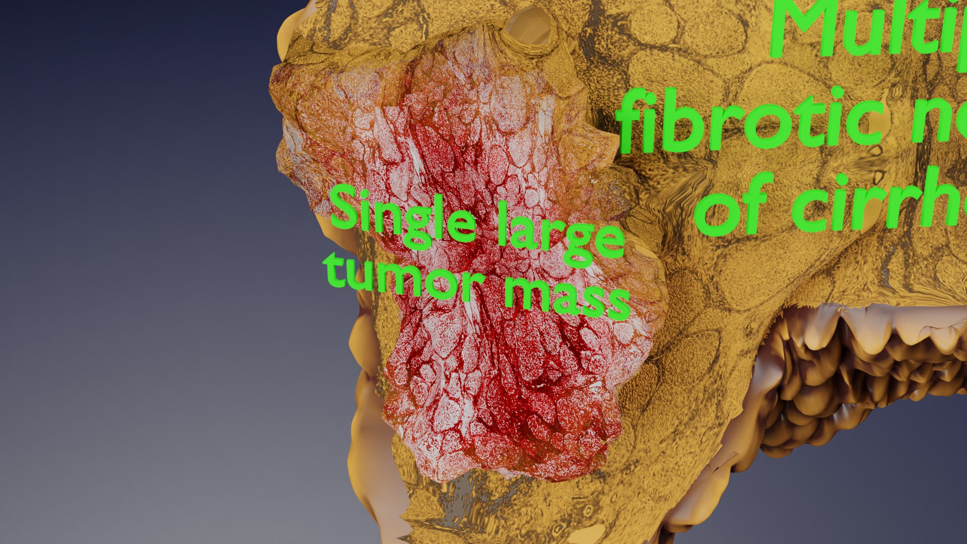 3D Liver Cancer HCC Vs Metastatic - TurboSquid 1981576