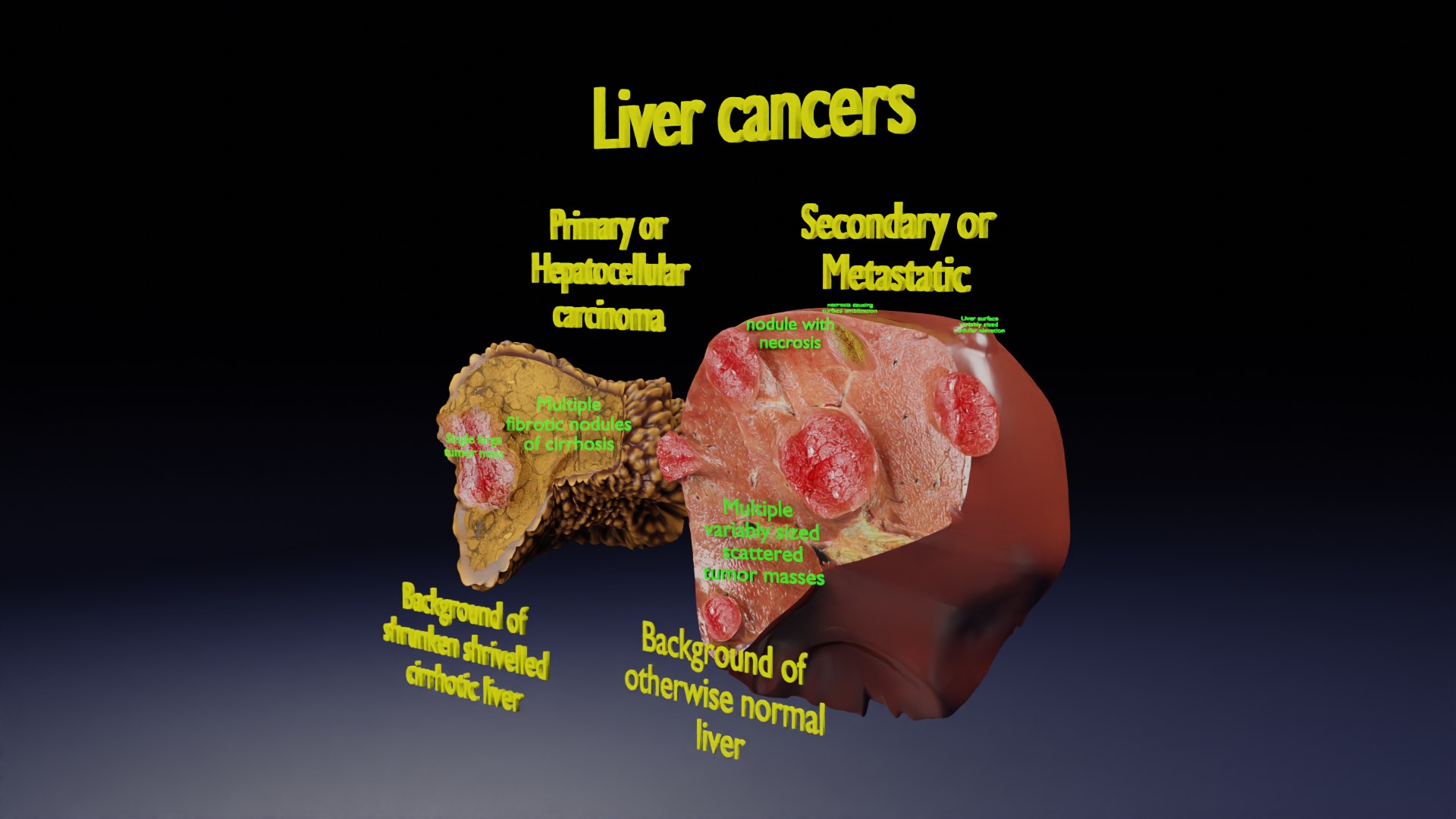 3D Liver Cancer HCC Vs Metastatic - TurboSquid 1981576