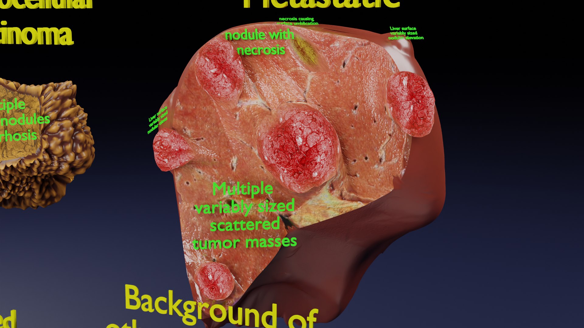 3D Liver Cancer HCC Vs Metastatic - TurboSquid 1981576