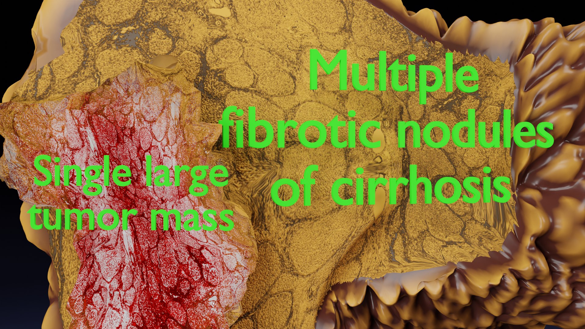 3D Liver cancer HCC vs Metastatic - TurboSquid 1981576