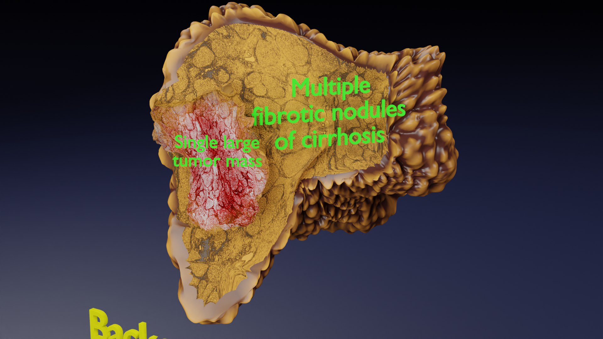 3D Liver Cancer HCC Vs Metastatic - TurboSquid 1981576