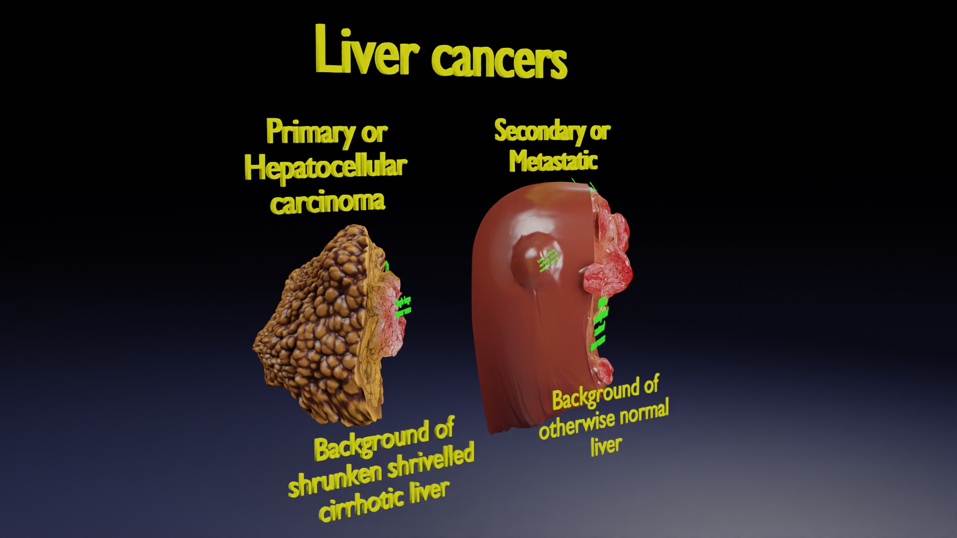 3D Liver Cancer HCC Vs Metastatic - TurboSquid 1981576