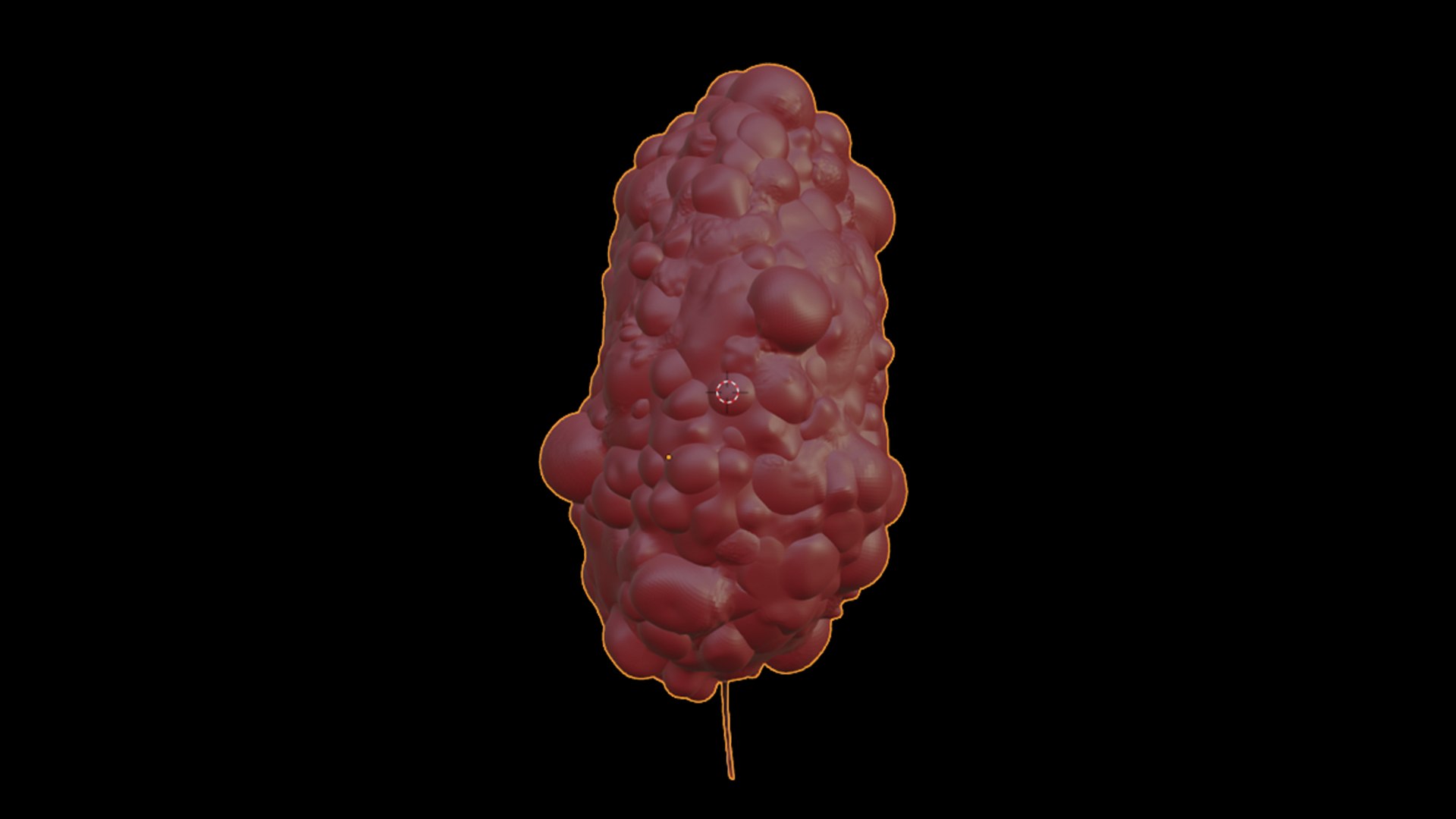 3D Model Of Polycystic Kidney 3D - TurboSquid 2076994