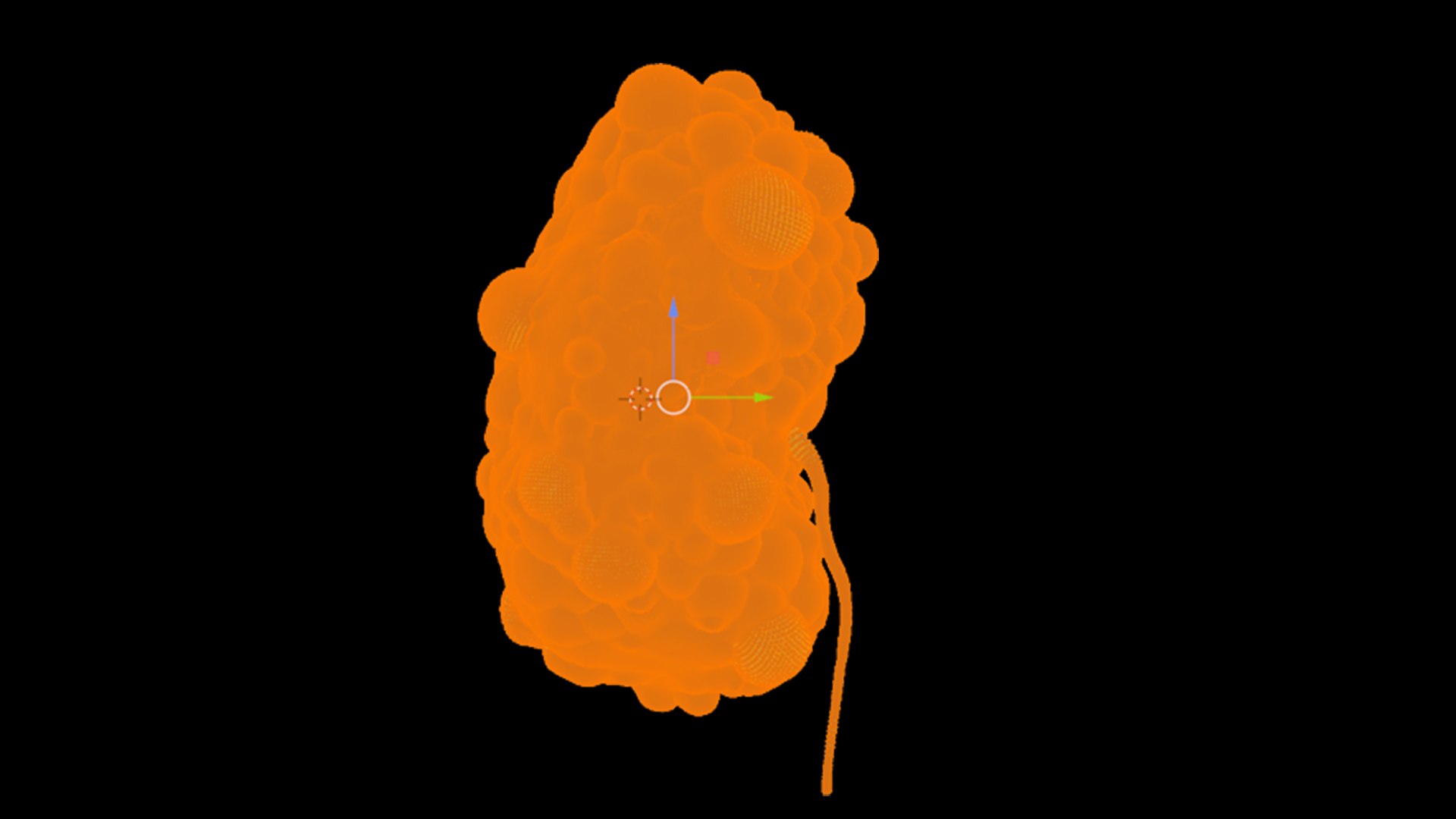 3D Model Of Polycystic Kidney 3D - TurboSquid 2076994