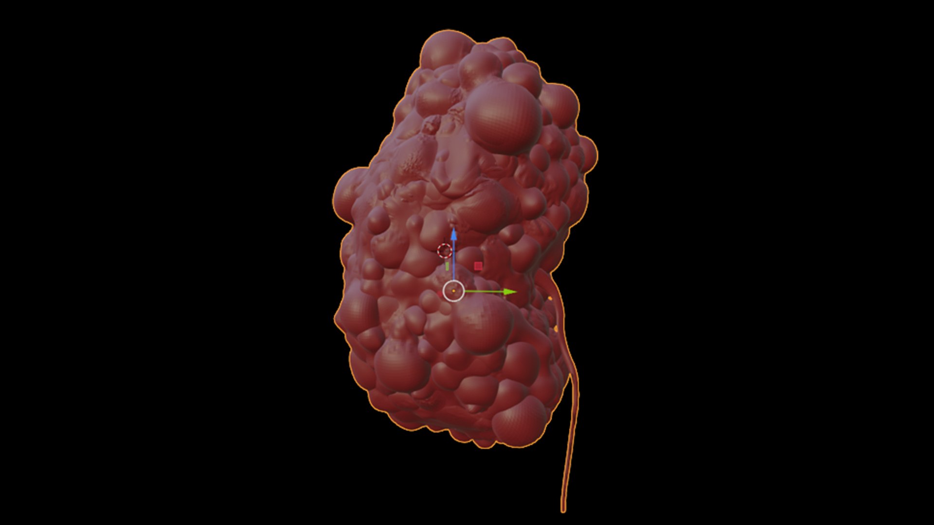 3D Model of Polycystic Kidney 3D - TurboSquid 2076994