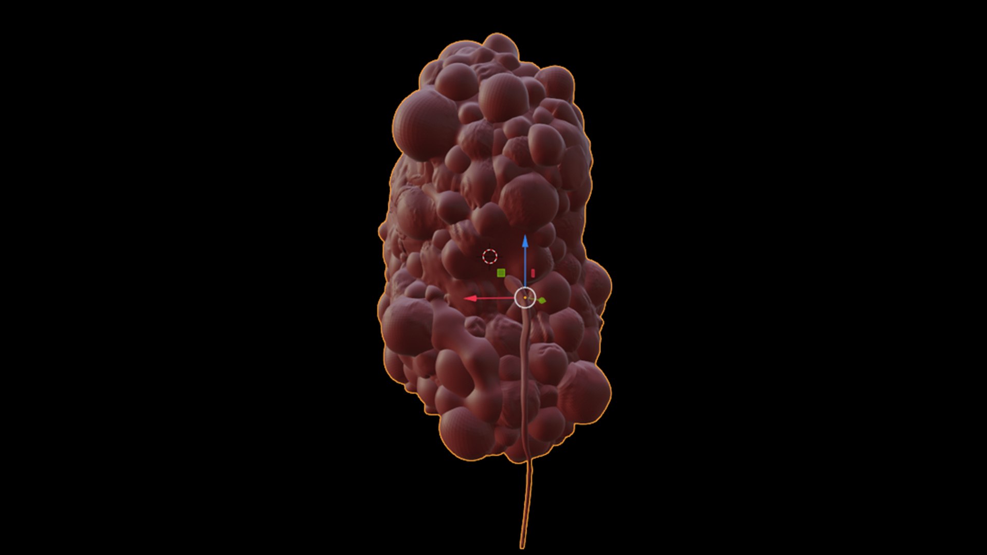 3D Model Of Polycystic Kidney 3D - TurboSquid 2076994