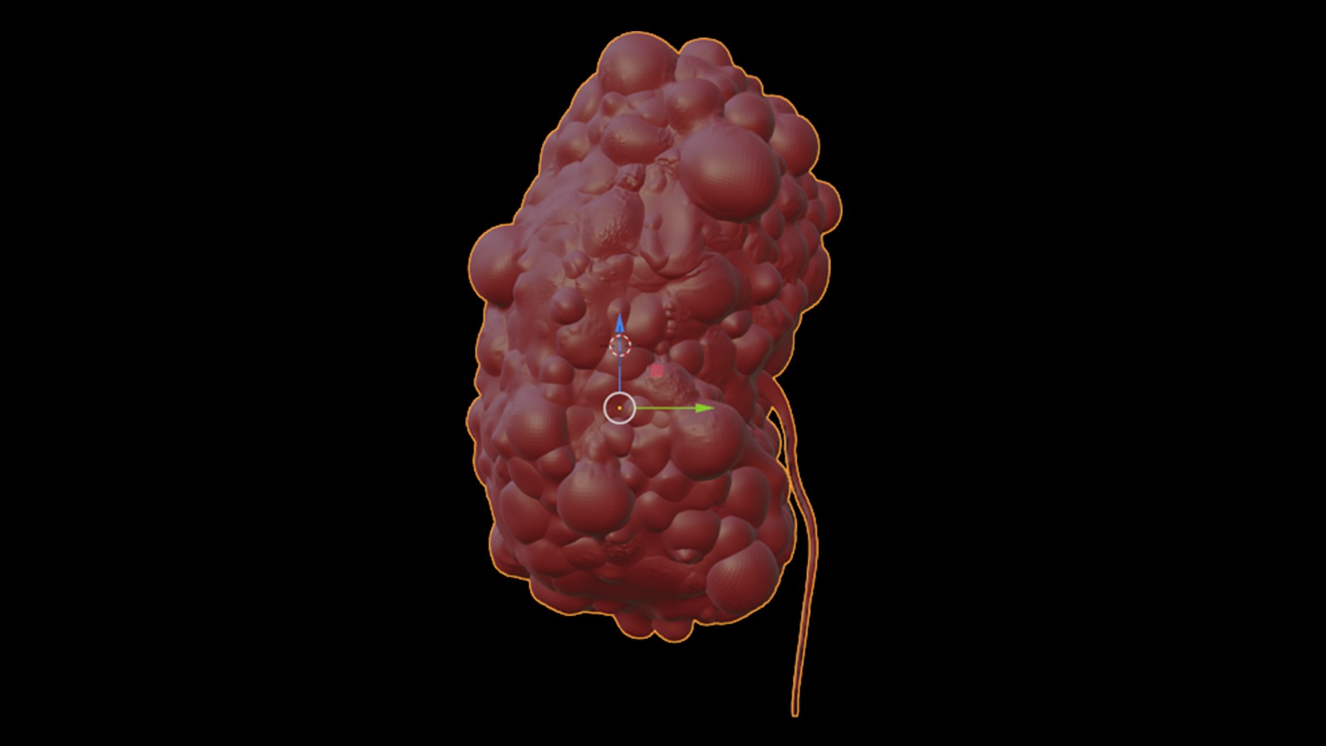 3D Model Of Polycystic Kidney 3D - TurboSquid 2076994