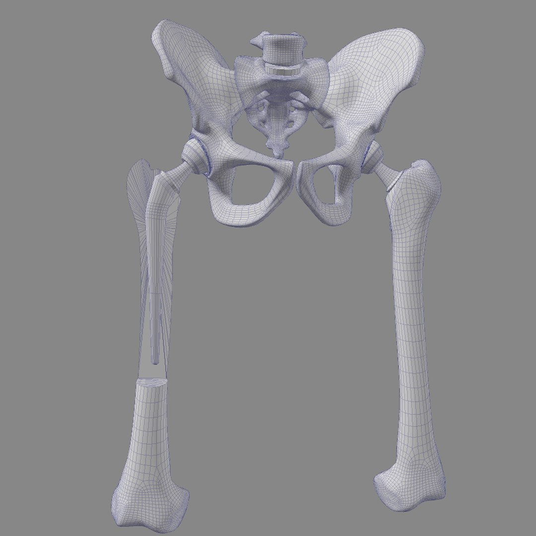 Replacement hip 3D - TurboSquid 1520195