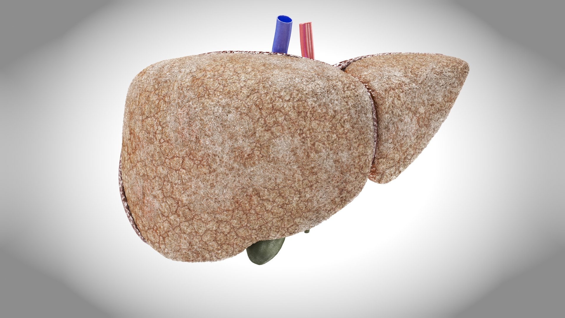 Fibrosis Liver 3D Model - TurboSquid 2132831
