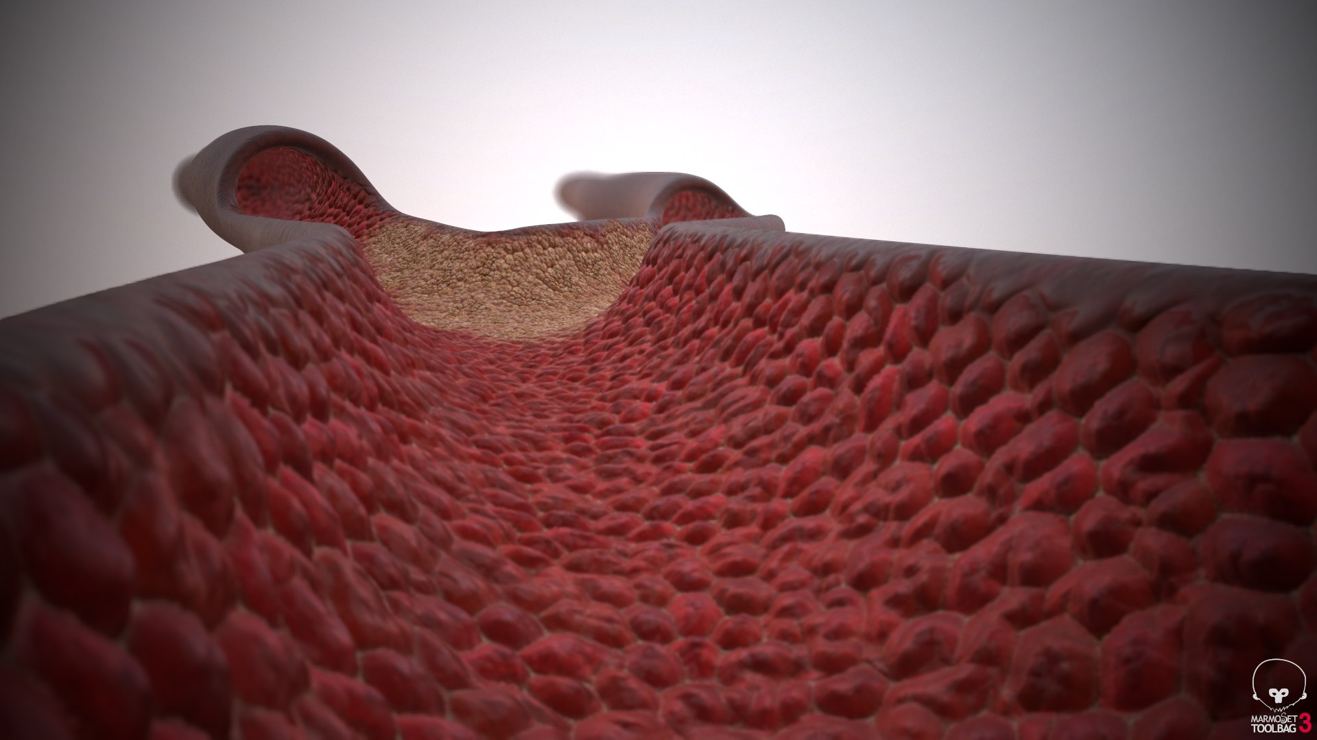 Atherosclerosis 3D Model - TurboSquid 1359855