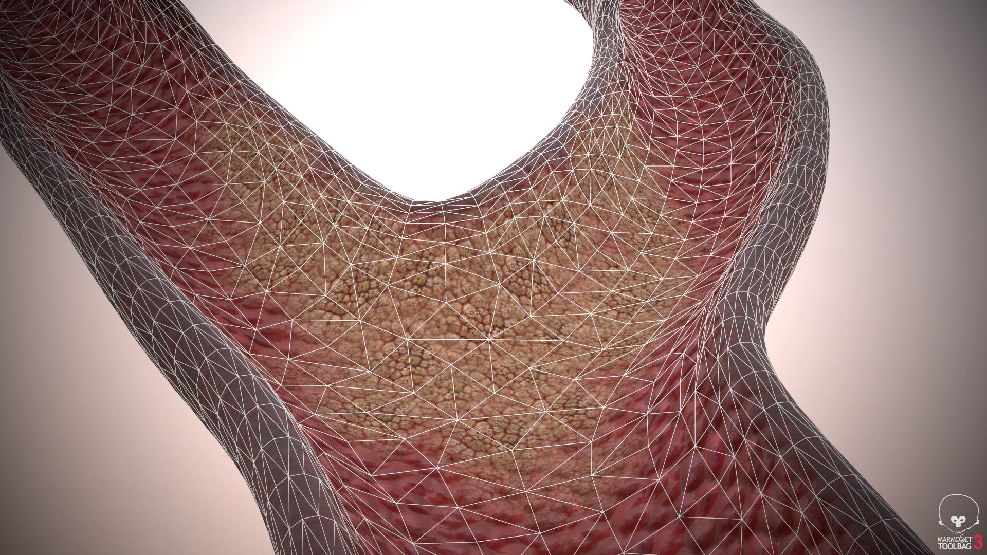 Atherosclerosis 3D model - TurboSquid 1359855