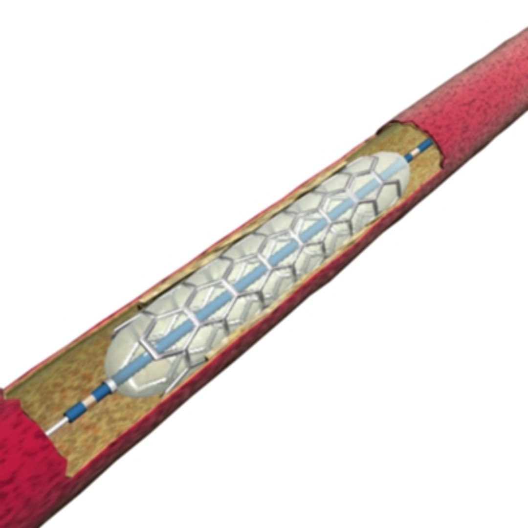 Stent Angioplasty Balloon 3d Max