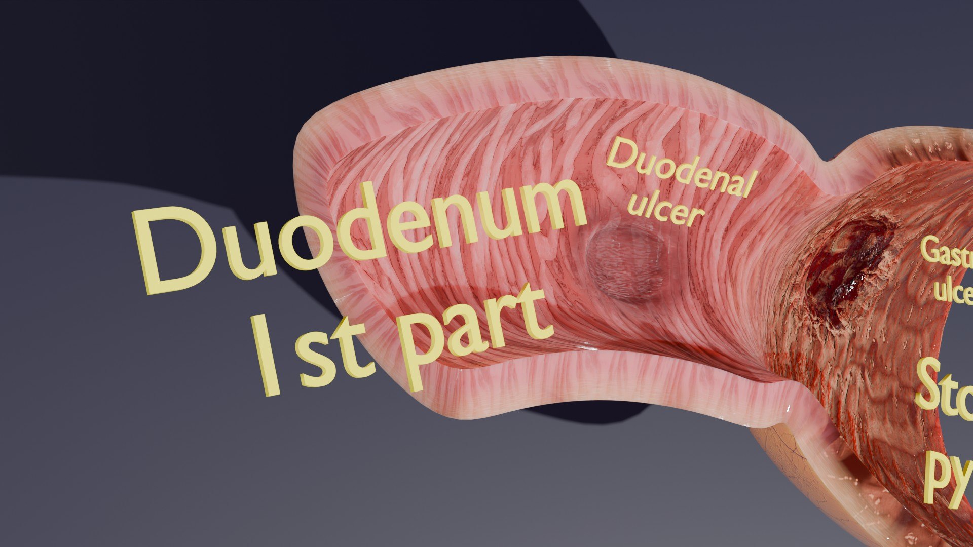 3D Peptic Ulcer Stomach Duodenum - TurboSquid 2429849