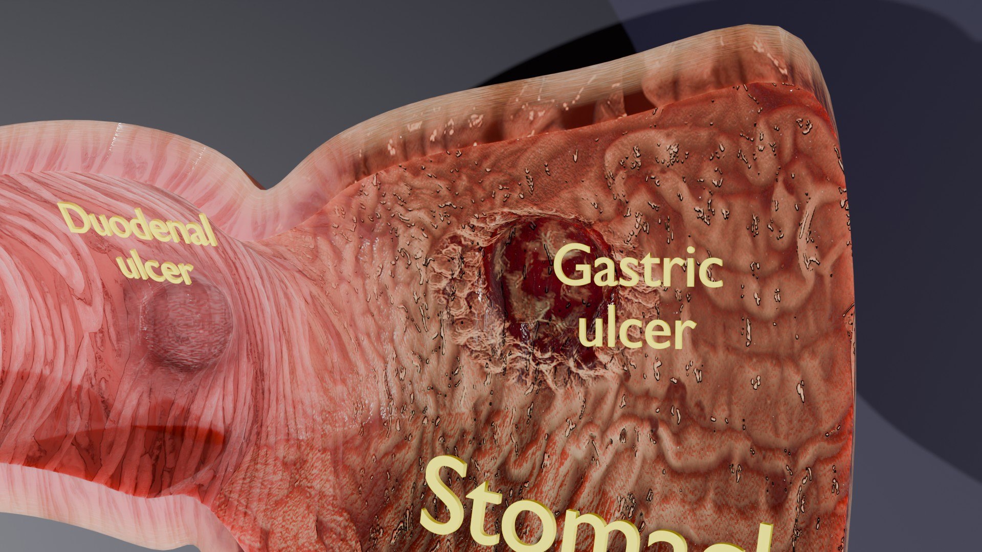 3D Peptic Ulcer Stomach Duodenum - TurboSquid 2429849