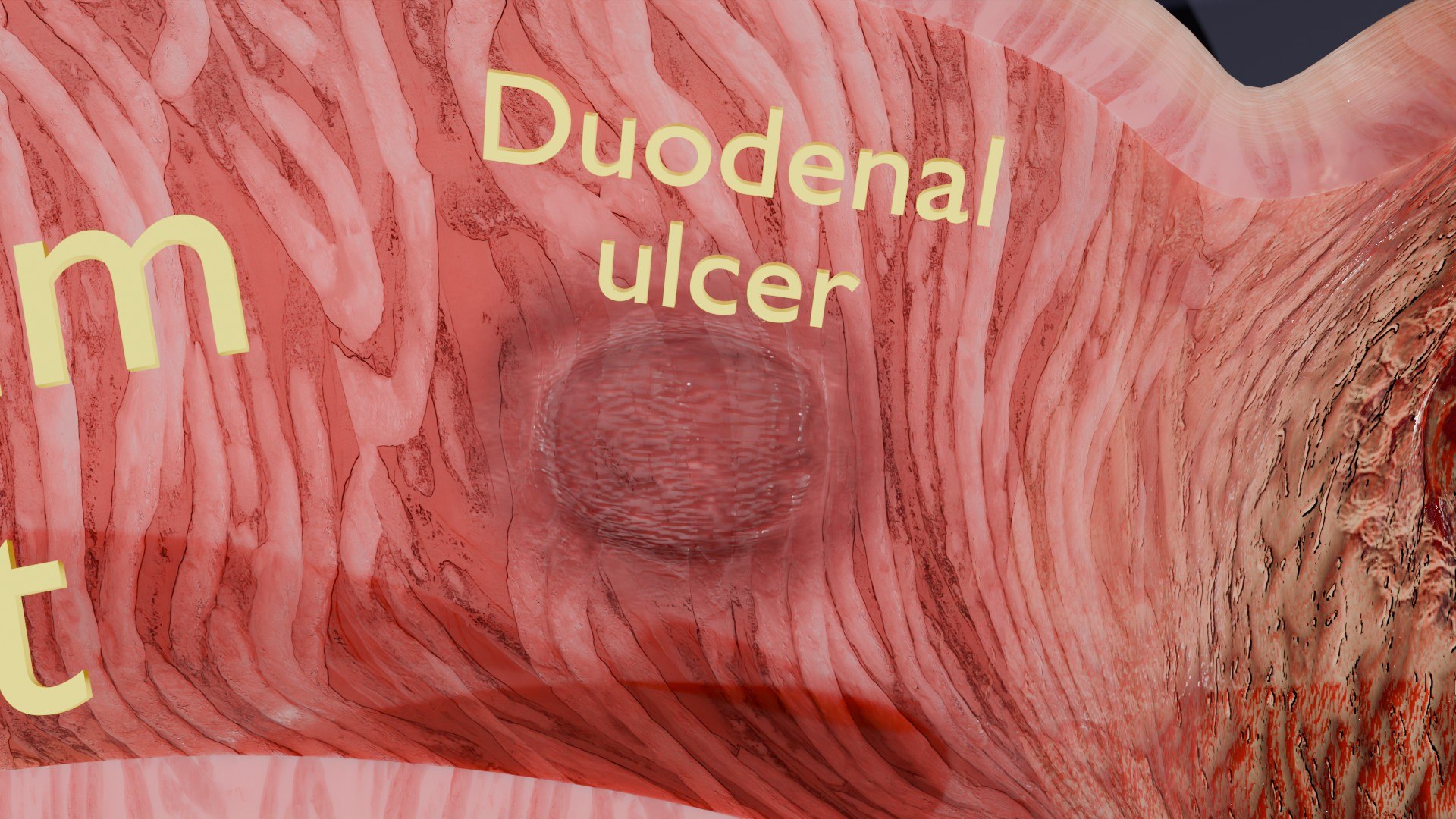 3D Peptic Ulcer Stomach Duodenum - TurboSquid 2429849