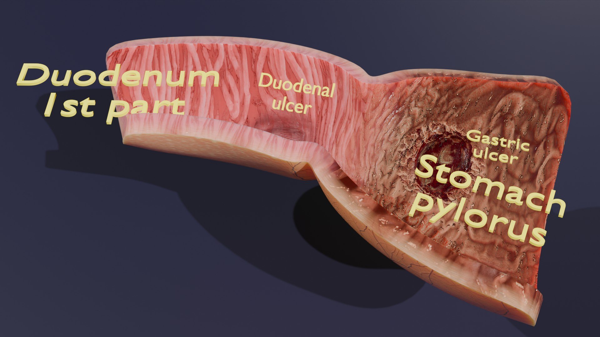 3D Peptic Ulcer Stomach Duodenum - TurboSquid 2429849