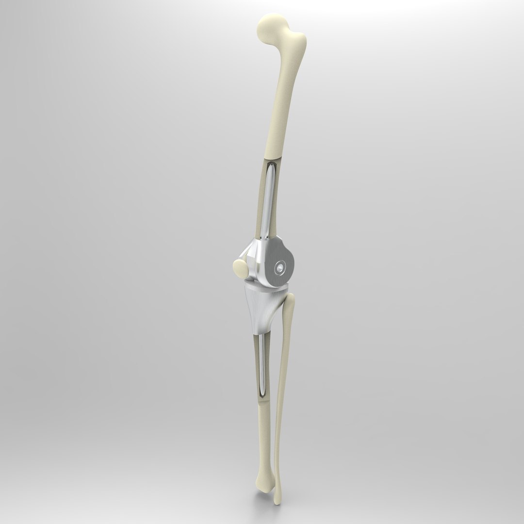 Knee Tumor Prosthesis 3D - TurboSquid 1464660