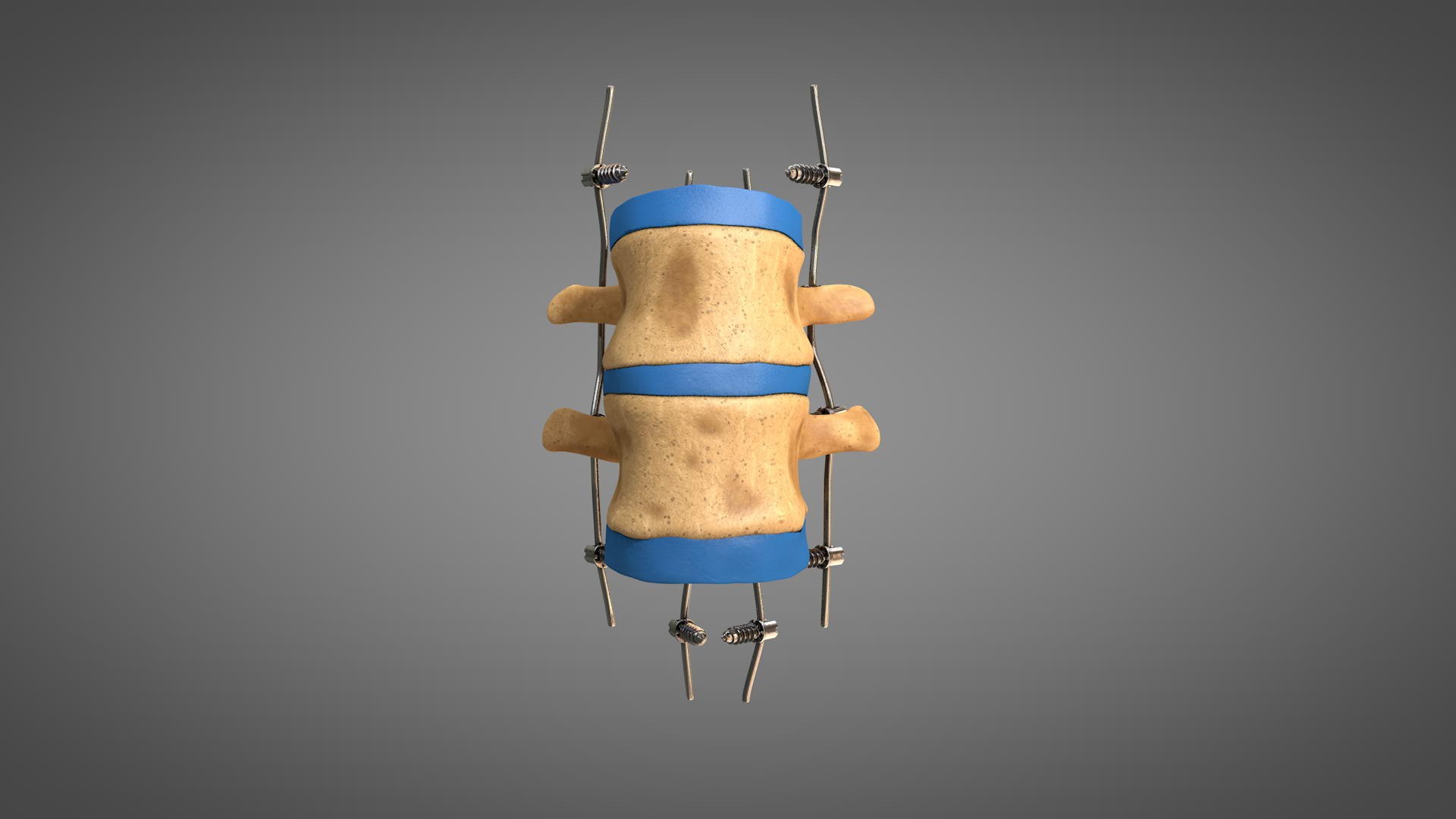 3D human spine fixators model - TurboSquid 1332651