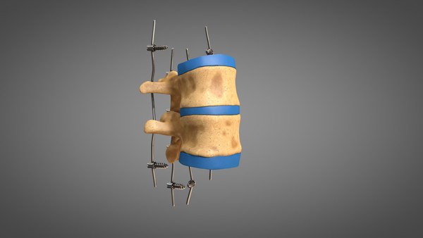 3D human spine fixators model - TurboSquid 1332651
