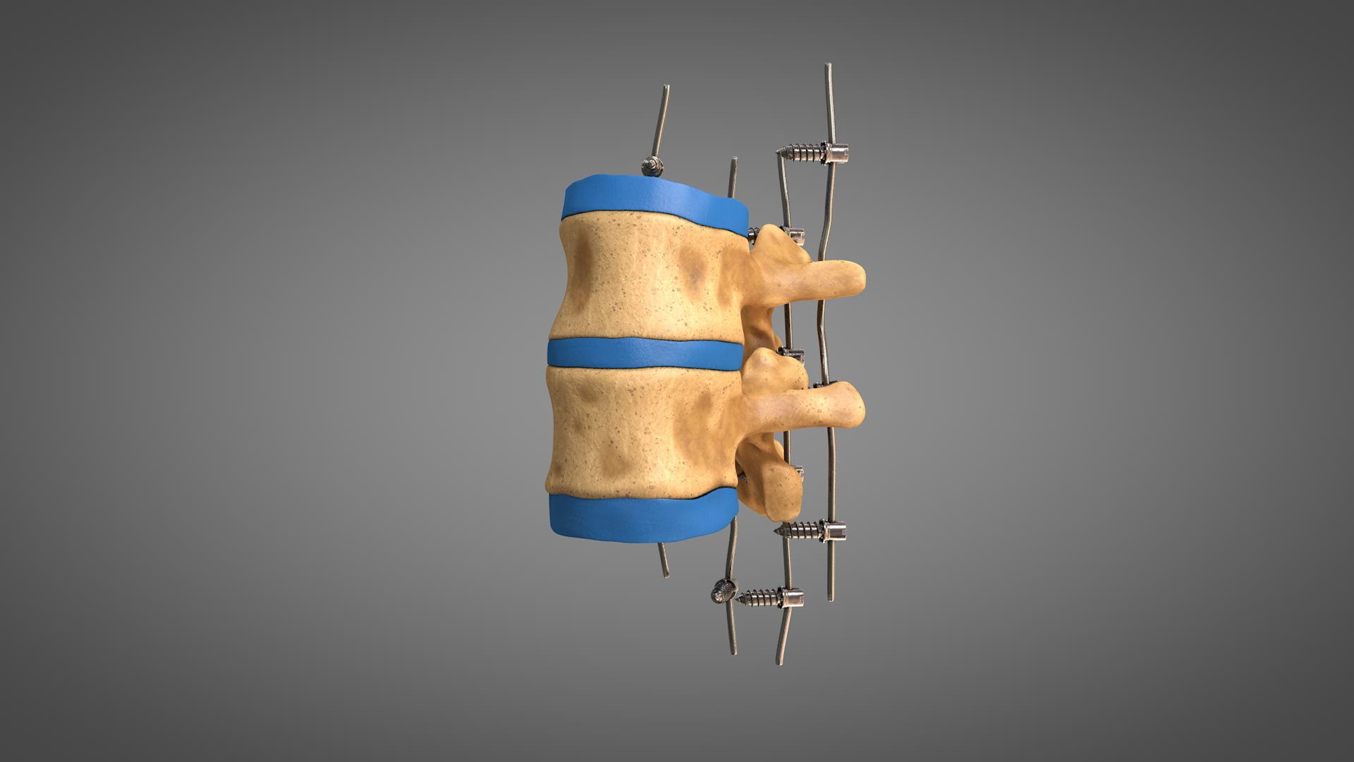 3D human spine fixators model - TurboSquid 1332651