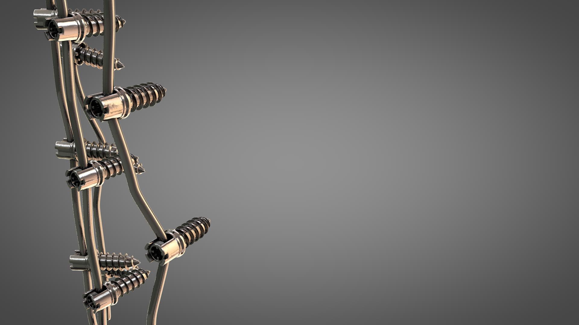 3D human spine fixators model - TurboSquid 1332651