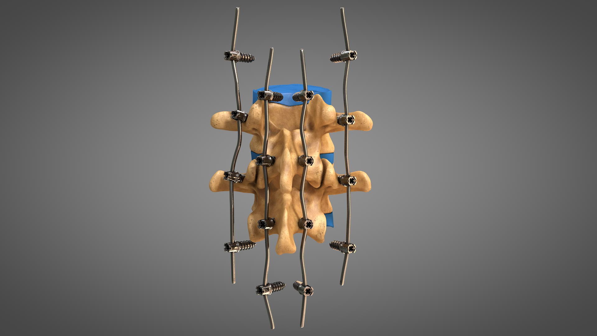 3D human spine fixators model - TurboSquid 1332651