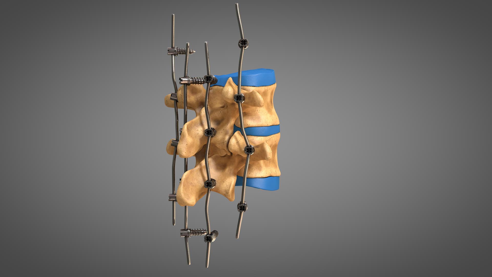 3D human spine fixators model - TurboSquid 1332651