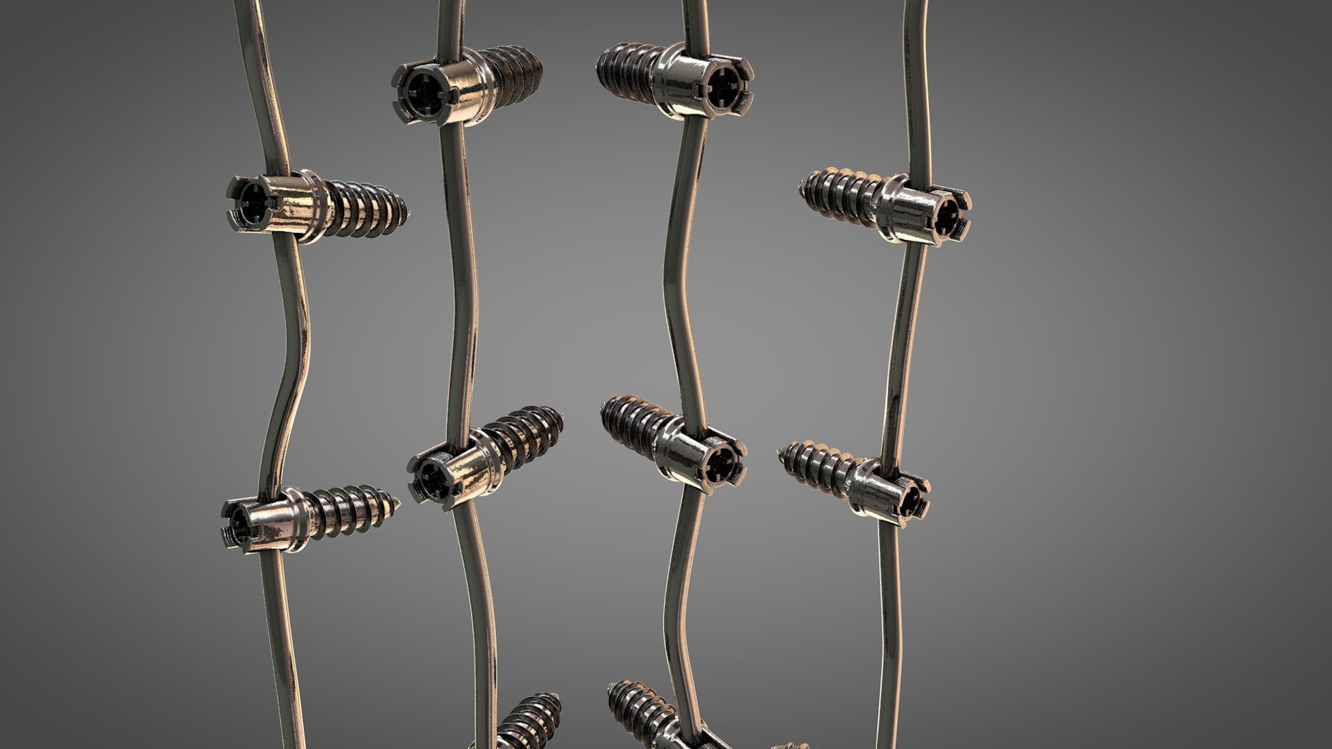 3D human spine fixators model - TurboSquid 1332651