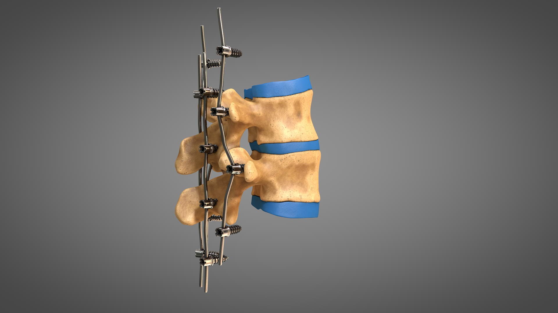 3D human spine fixators model - TurboSquid 1332651