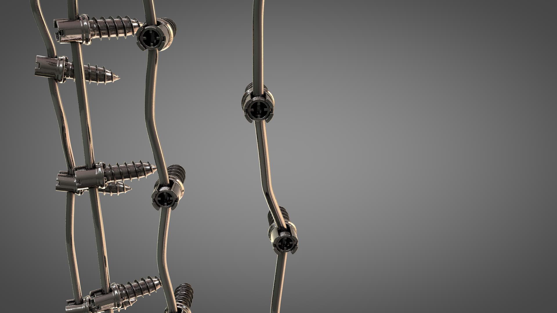 3D human spine fixators model - TurboSquid 1332651