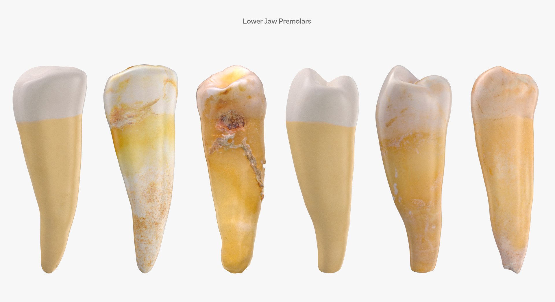 3D Human Lower Jaw Premolars Teeth Clean and Damaged Collection - 6 ...