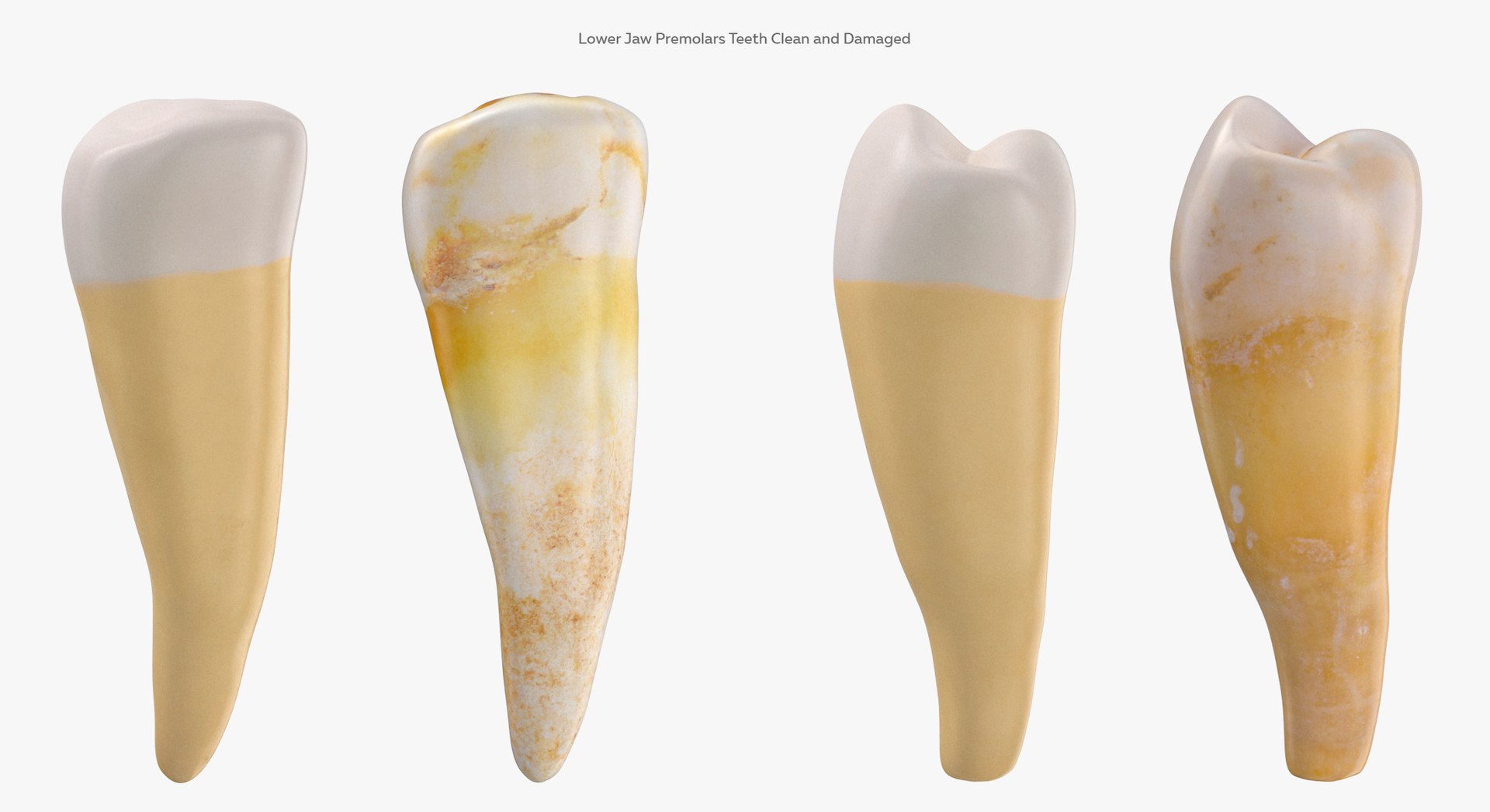 3D Human Lower Jaw Premolars Teeth Clean and Damaged Collection - 6 ...