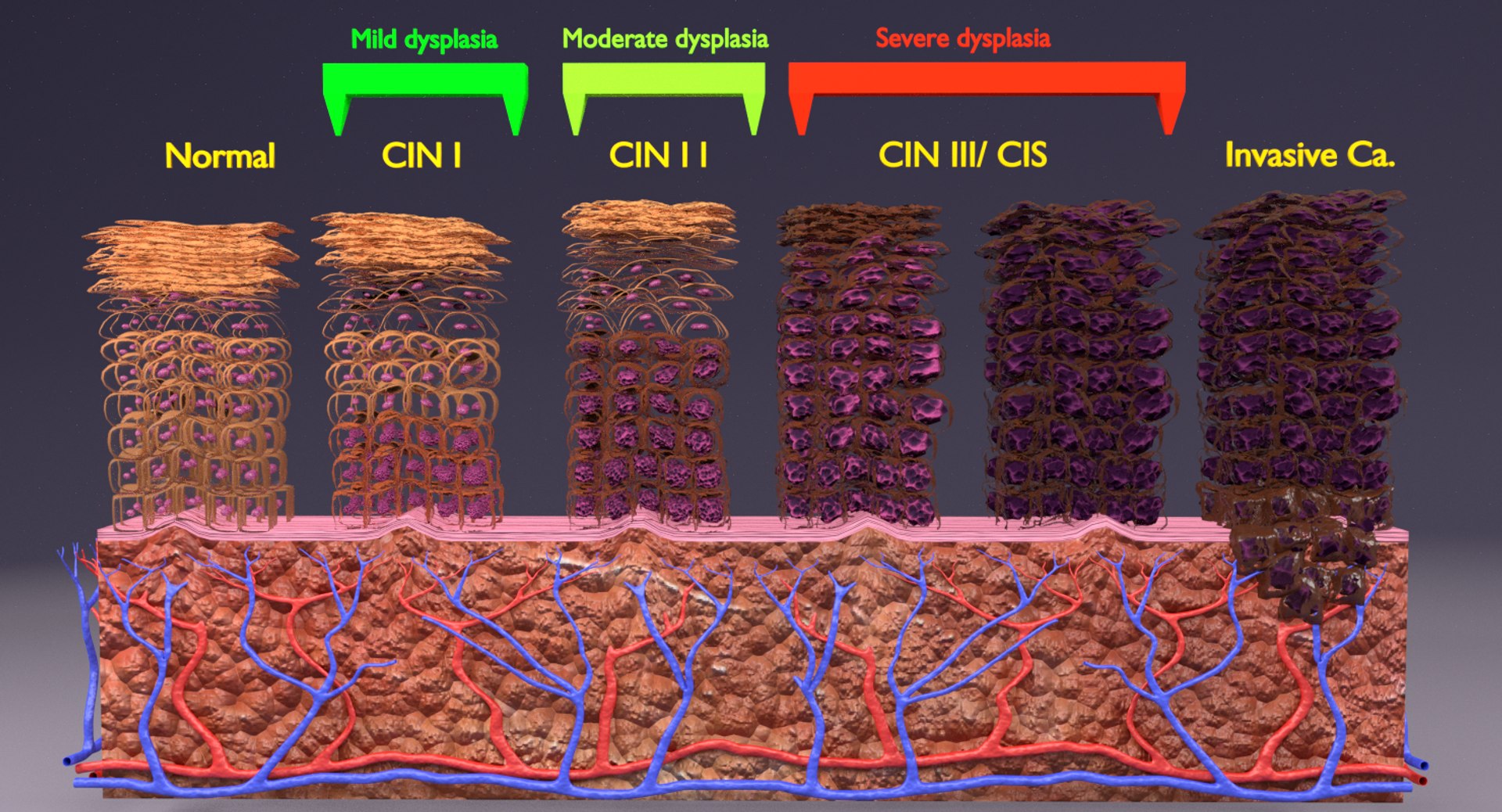 Cervical Cancer Cin 3D Model - TurboSquid 1368649