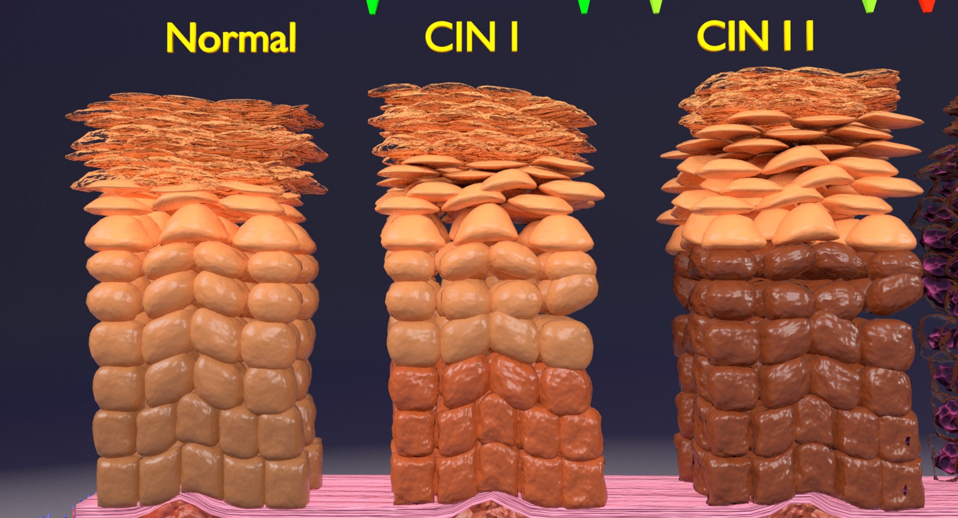 Cervical Cancer Cin 3D Model - TurboSquid 1368649