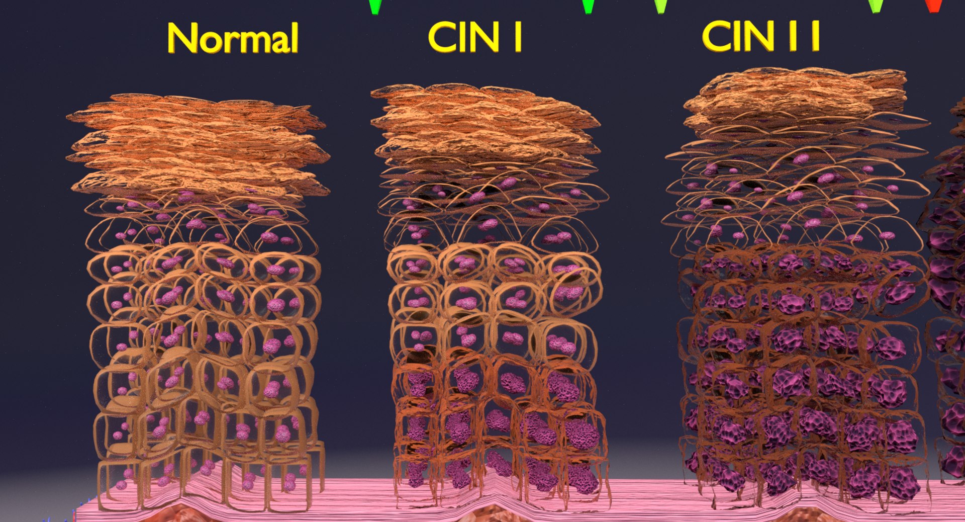 Cervical Cancer Cin 3D Model - TurboSquid 1368649