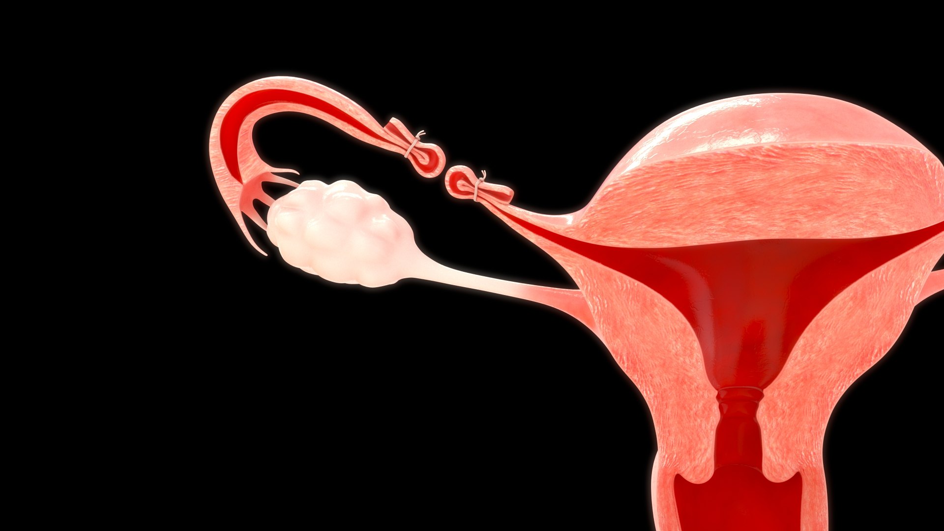 3D Tubectomy - TurboSquid 2309902