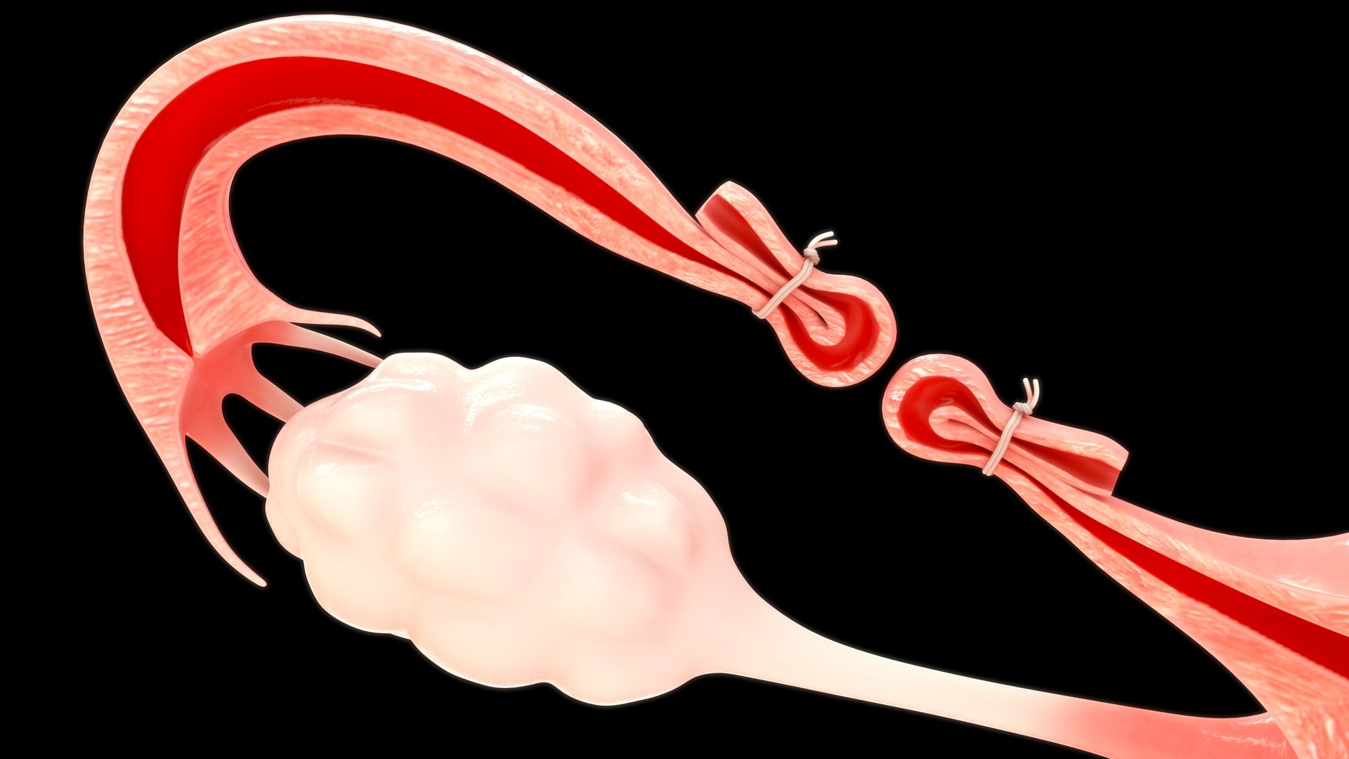 3D Tubectomy - TurboSquid 2309902