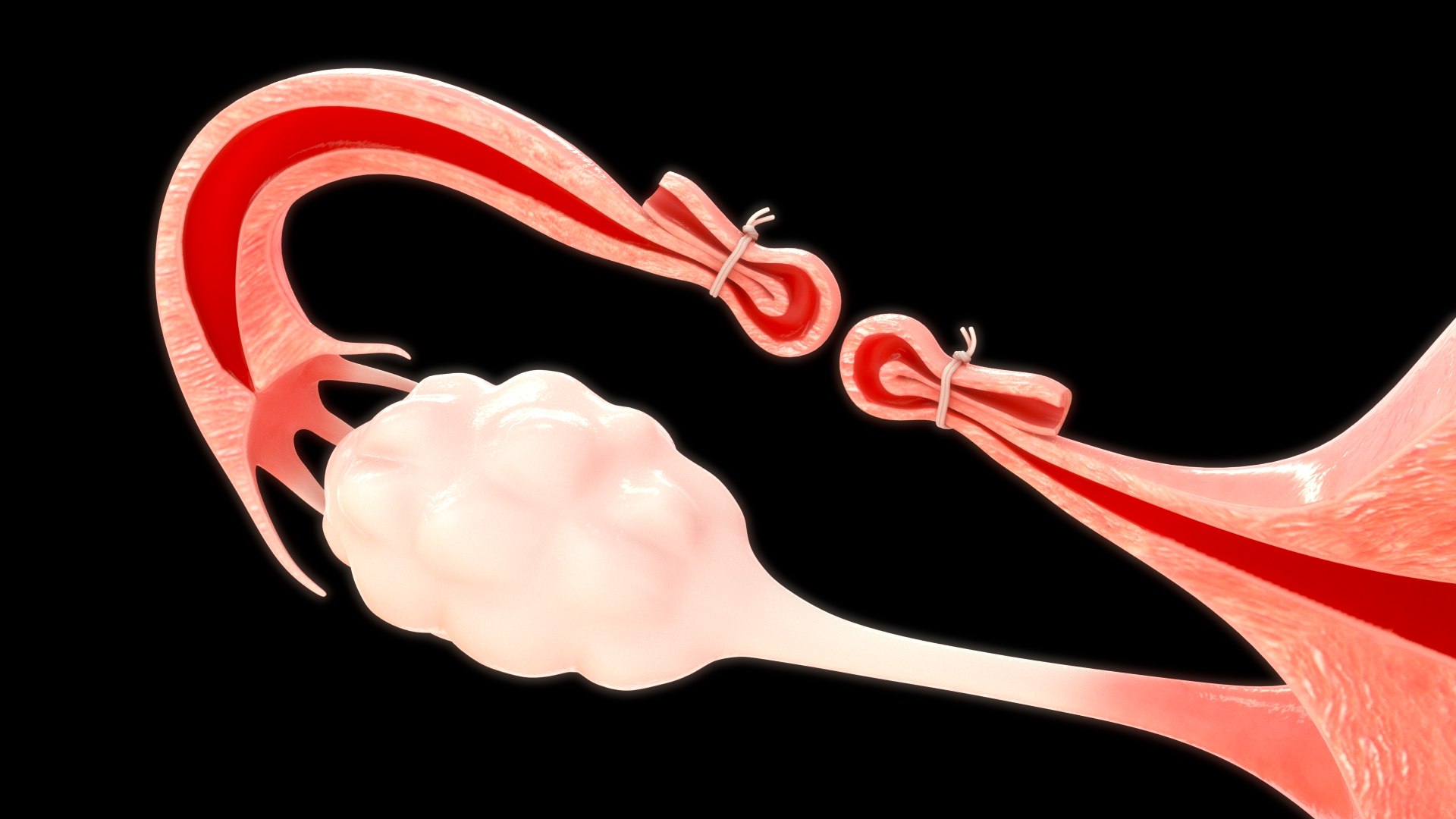 3D Tubectomy - TurboSquid 2309902