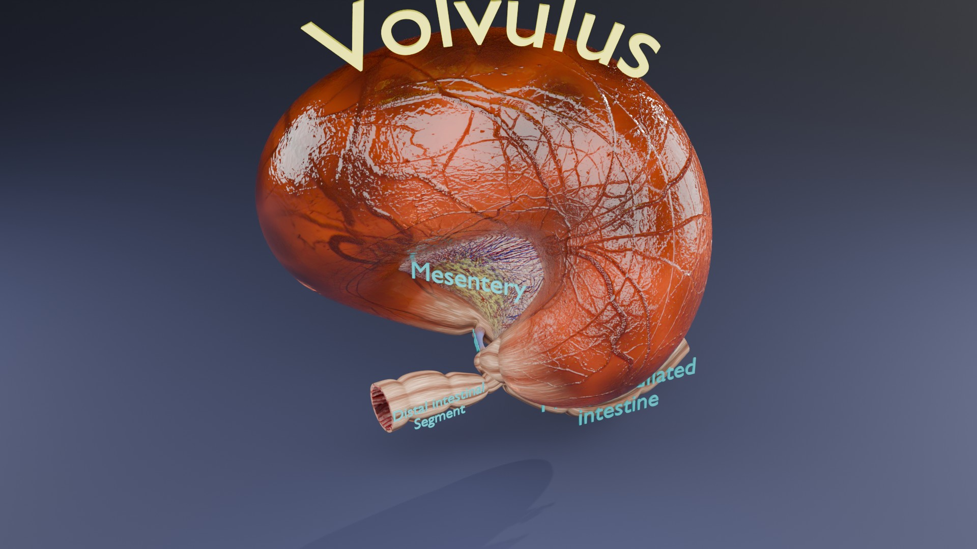 Volvulus Intestine Obstruction 3D - TurboSquid 2411401