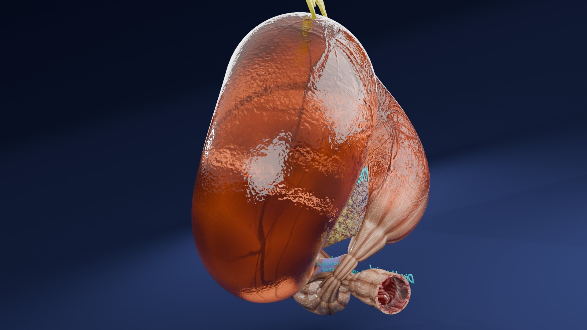 Volvulus Intestine Obstruction 3D - TurboSquid 2411401