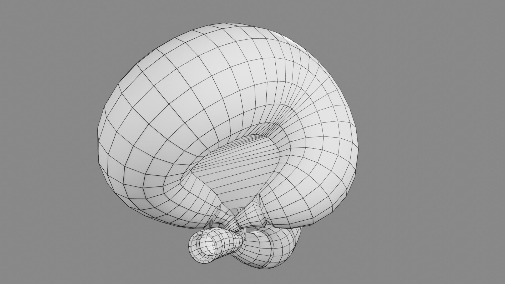 Volvulus Intestine Obstruction 3D - TurboSquid 2411401